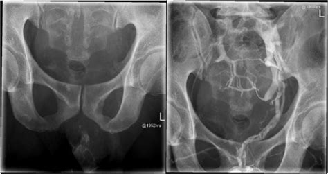 Retrograde Urethrogram Showing Contrast Extravasation Into The Pelvic