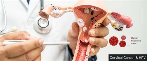 Cervical Cancer Facts Rose Foundation