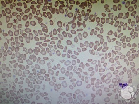 Hereditary Pyropoikilocytosis Spta1 Gene Pathologic Variant