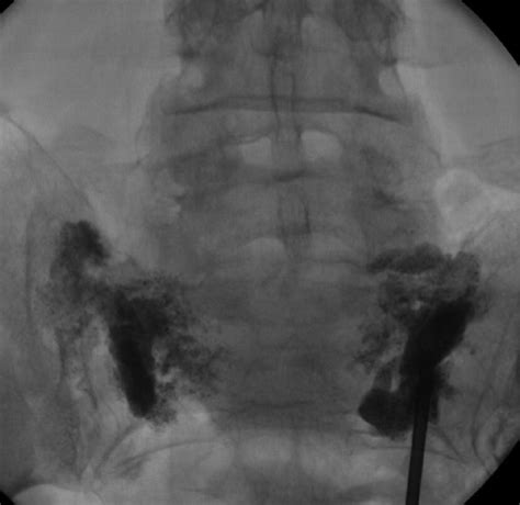 Sacral Insufficiency Fracture Spine Orthobullets