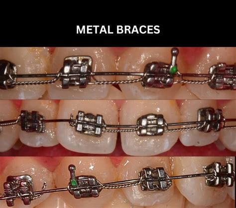 Metal Braces Vs Ceramic Braces Which Is Better For You
