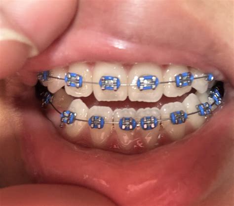 Finally Closing Extraction Gap Rbraces