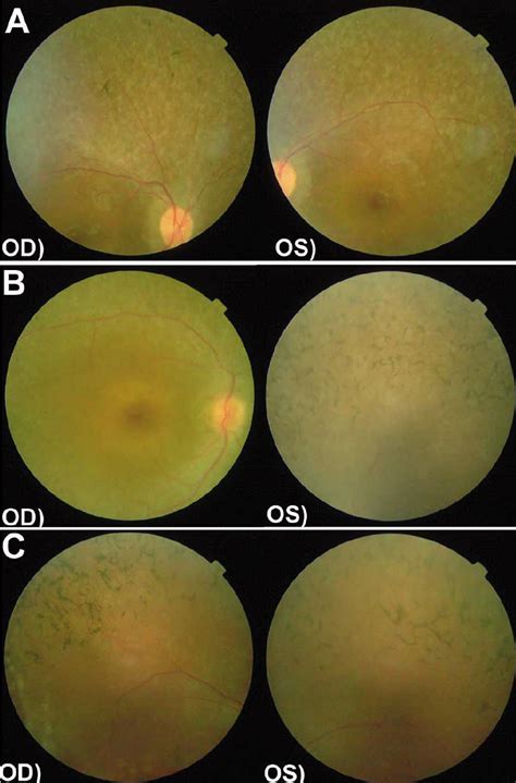 Fundus Photograps Of Affected Individuals Funduscopy Photographs Of