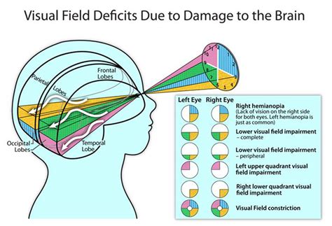 Quadrantanopia Visual Field Defect Medbullets On X Contralateral
