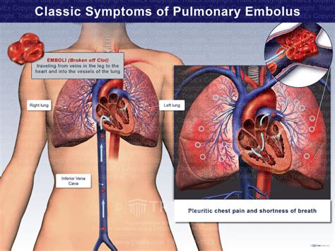 Classic Symptoms Of Pulmonary Embolus Trialquest Inc