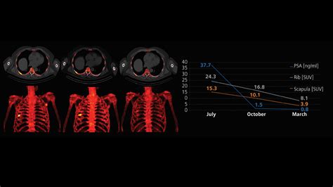 Clinical Impact Of Absolute Spectct Quantification In Theranostics And