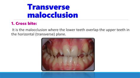 Transverse Malocclusion Crossbite Pptx