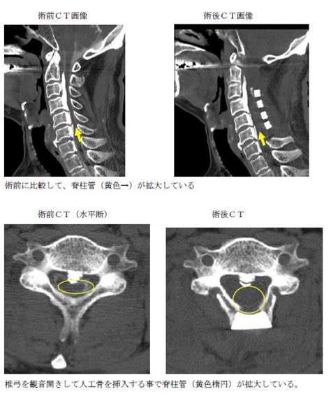 脊椎脊髄 靱帯骨化症