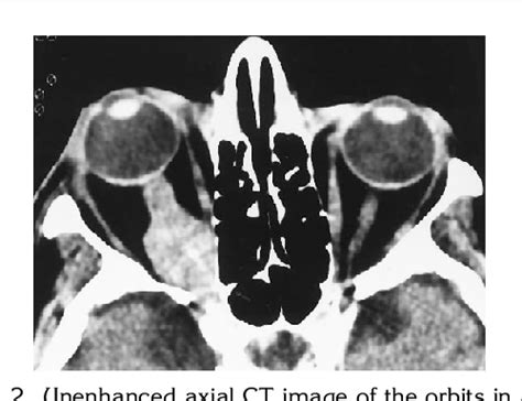 Figure 2 From The Optic Nerve Sheath Radiologic Pathologic Correlation Meningioma Of