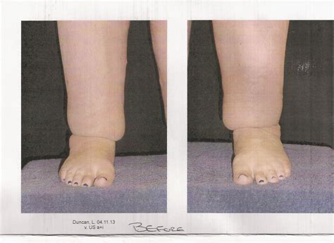 Lipo Lymphedema My Surgery Journal January 2014