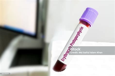 적혈구 프로토퍼피린 검사를 위한 혈액 샘플 튜브 빈혈 질환 진단 0명에 대한 스톡 사진 및 기타 이미지 0명 European Peoples Party 건강 진단