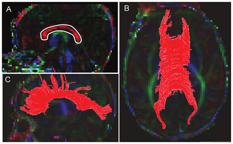 Location Of Single Roi On Dti Color Maps For The Corpus Callosum Cc Download Scientific