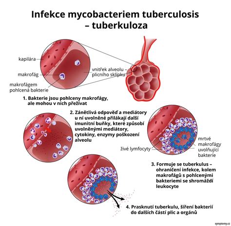 Tuberkulóza Příznaky A Léčba