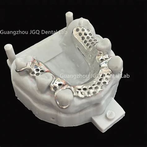 Partial Denture Removable Dentures Durable Dental Prosthesis Metal