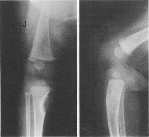 Month Old Female Presented With A Mass In The Proximal Tibia Download Scientific Diagram