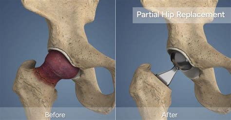 Understanding Bipolar Hemiarthroplasty Vs Total Hip Replacement Jain Multispecality Hospital