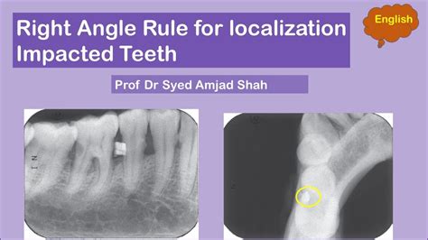 Right Angle Rule For Localization Impacted Teeth Syed Amjad Shah