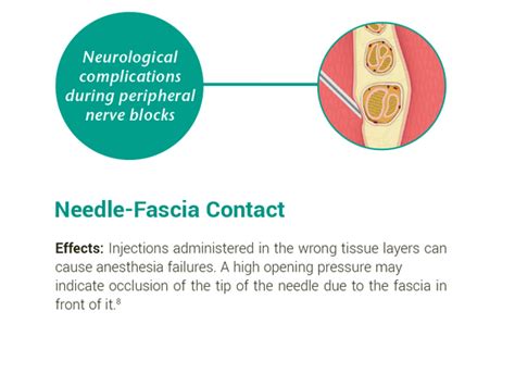 Nerveguard Automatic Injection Pressure Limiter Pajunk