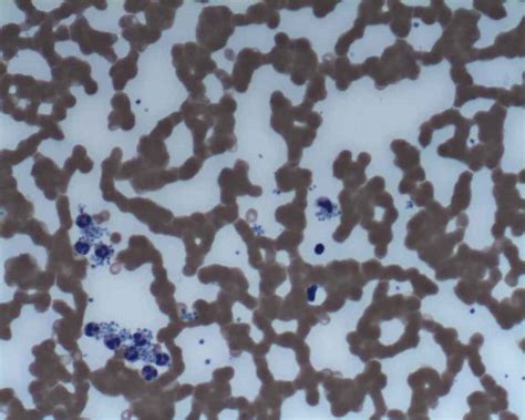 Platelet Abnormalities HEMATOLOGY