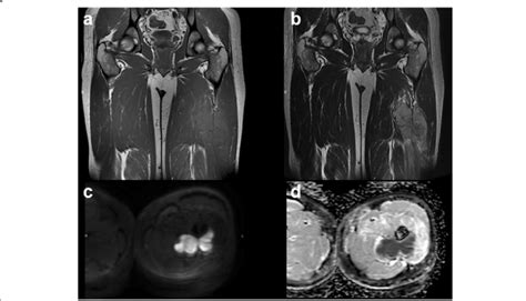 Thirty Nine Years Old Girl With A Primitive Neuroectodermal Tumour Download Scientific Diagram