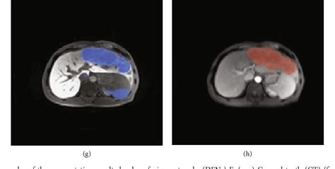 Figure 7 From Deep Learning Combined With Radiologists Intervention Achieves Accurate