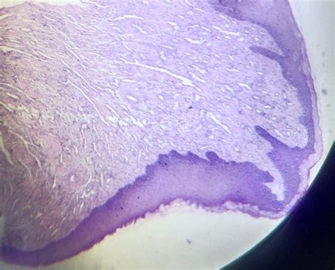 Lower Lip Nodule Dr Nakul Sampat