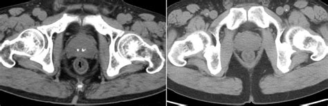 Ct Shows Prostate Calcification Worsens Ipss Scores