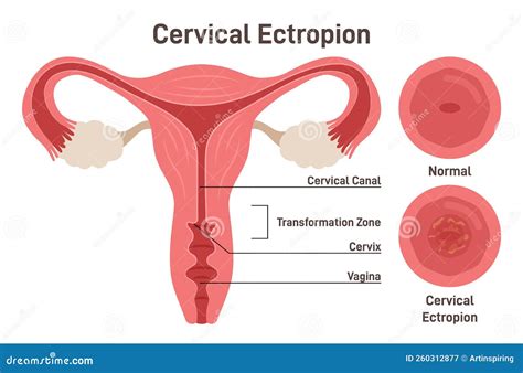 Cervical Ectropion Cervical Erosion Cartoon Vector