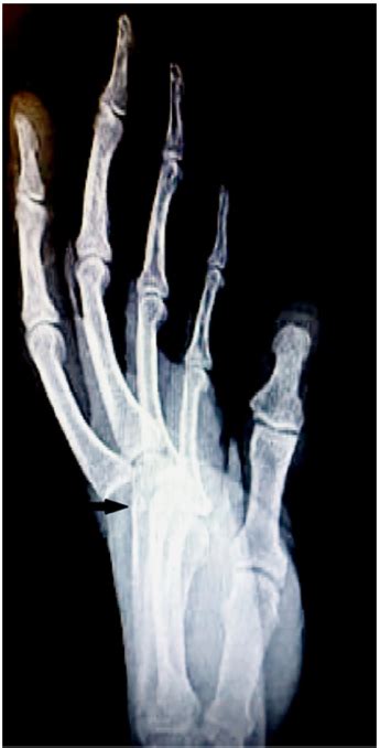 X Rays Showing Dorsal Mcpj Dislocation Of The Index Finger With Download Scientific Diagram