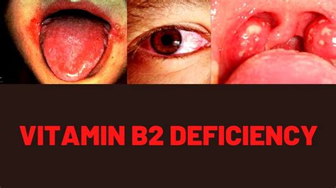 Vitamin B2 Deficiency Riboflavin Vitamin B2 The Nutrition Source
