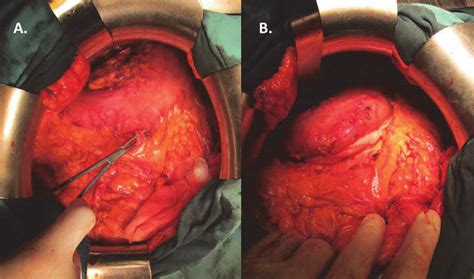 Perigastric Devascularization A Surgical Instrument Inserted