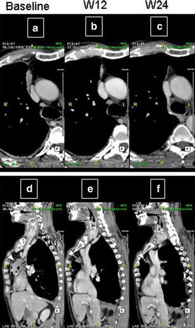 Ct Scan In Axial Plan Ac And Multiplanar Reformatting Sagittal Plane Download Scientific