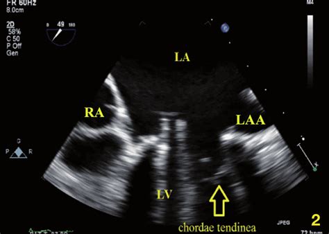 Transesophageal Echocardiography Images Indicate Residual Chordae