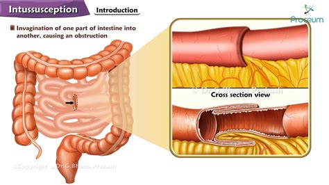 Intussusception Clinical Presentation Radiological Investigations