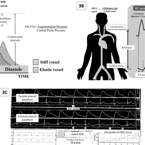 A Schematic Of An Arterial Pressure Waveform Showing Augmentation