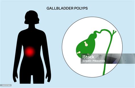 Gallbladder Polyp Anatomy Stock Illustration Download Image Now