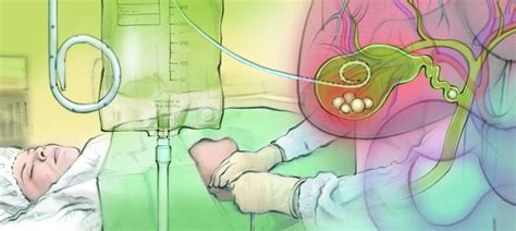 Gallbladder Drain — The Interventional Initiative