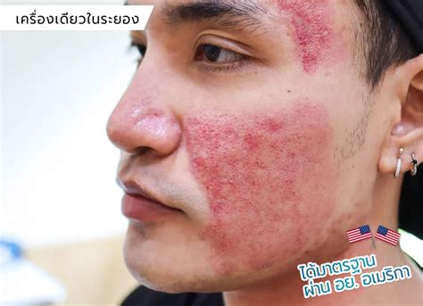 Pico Plus Doctor Non Clinic ฉีดฟิลเลอร์ ระยอง