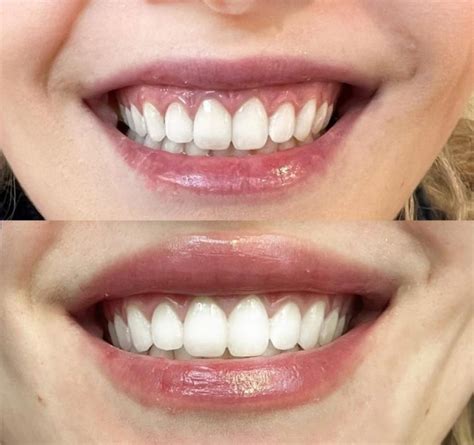 Lip Flip Before And After Photos And Everything You Need To Know