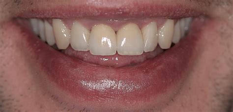 Chronische Hyperplastische Gingivitis Zwp Online Das Nachrichtenportal Für Die Dentalbranche