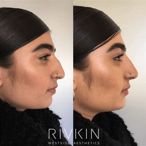Hispanic Nose Rivkin Aesthetics