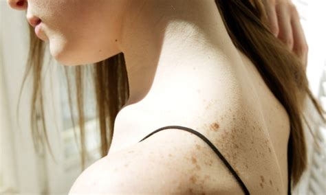 მე 2 ტიპის დიაბეტის სიმპტომი რომელიც შეიძლება გაჩნდეს ქუთუთოზე ყელზე იღლიაზე ან საზარდულზე