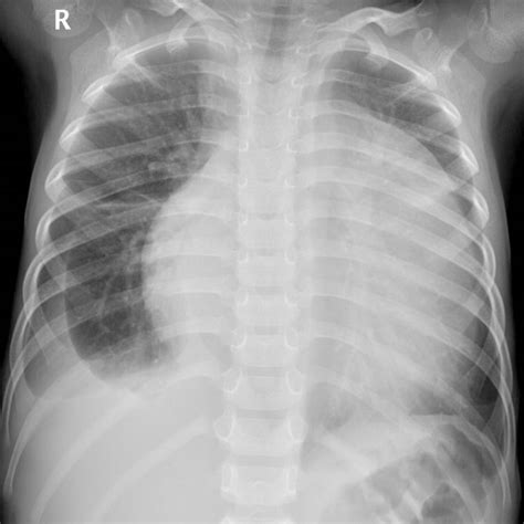 Chest Radiography Of Pericardial Primitive Neuroectodermal Tumor In A Download Scientific