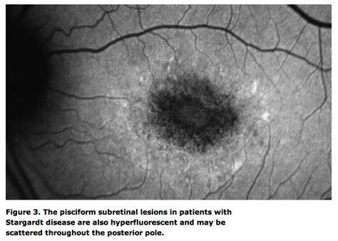 Autofluorescentie Faf