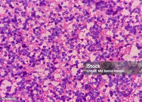 Usg는 간 Sol에서 Fna 세포학을 유도했습니다 비호 지킨 림프종 얼룩은 비정형 작은 원형 세포와 염증 세포 및 혈액 배경을 보여줍니다 전이성 암종 호지킨병에 대한 스톡