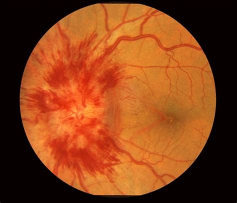 Optic Disc Edema Frontiers Pembrolizumab Induced Optic Neuropathy
