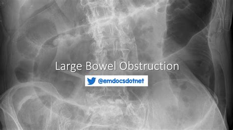 Emergency Medicine Educationlarge Bowel Obstruction Ed