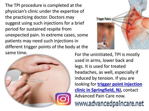 PPT Things Worth Knowing About Trigger Point Injection For Muscle Pain PowerPoint Presentation