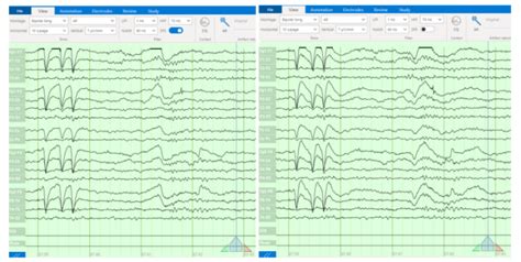How Digital Eeg Filters Impact Eeg Signal Morphology Zeto Eeg