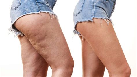 Radiofrecuencia En Lipodistrofia Ginecoide O Pefe Kinesteduca